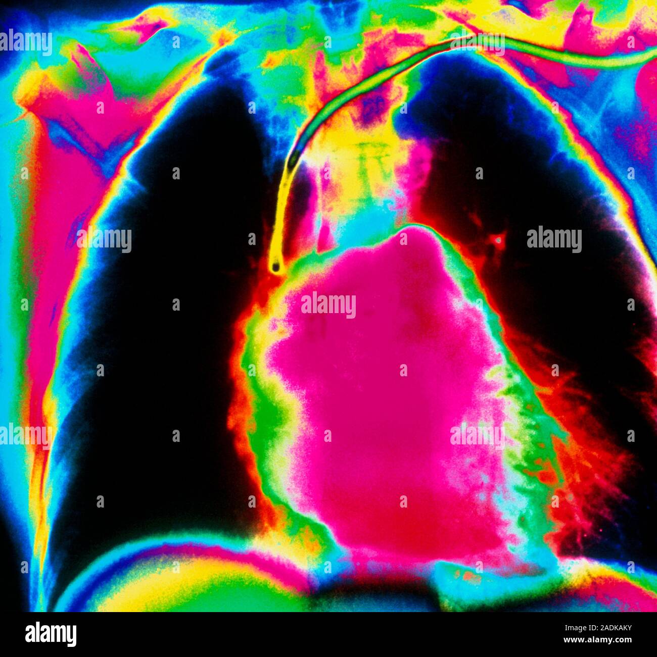 Healthy heart. Computer enhanced pulmonary angio- gram X-ray of a ...