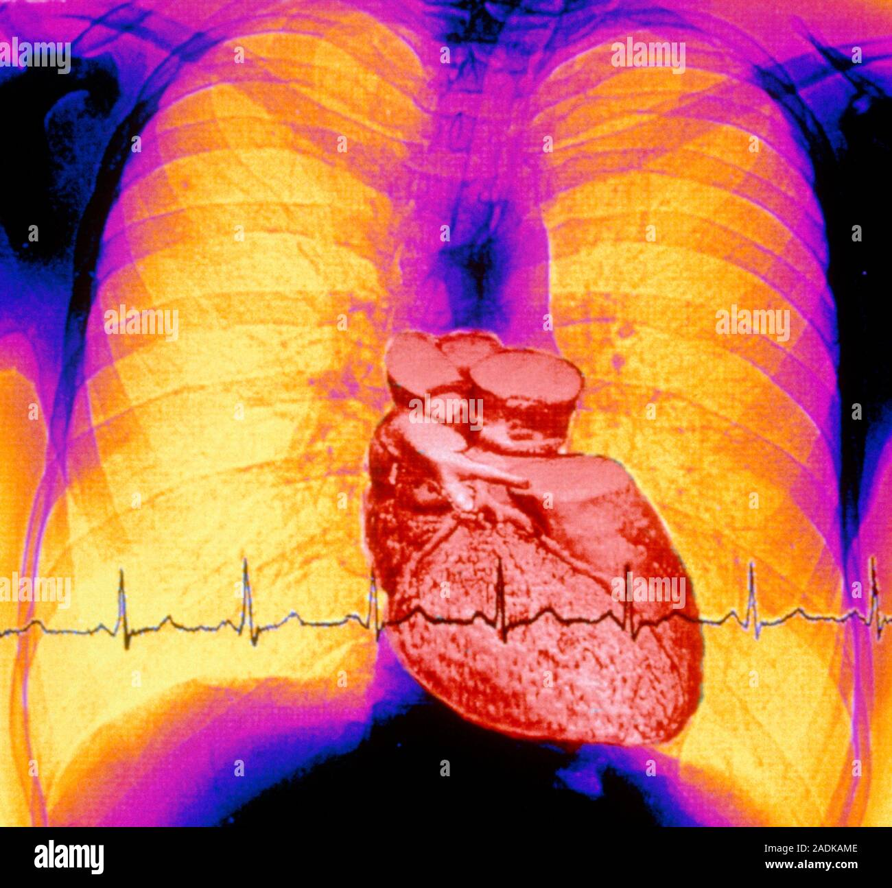 ECG trace with healthy heart & chest. Colour X-ray image of a human ...
