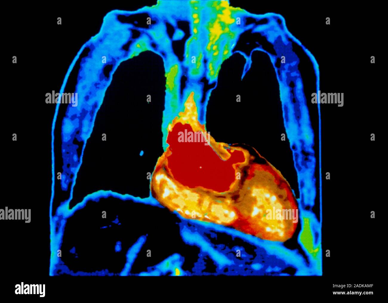 Healthy heart and lungs. Coloured Magnetic Resonance Imaging (MRI) scan ...