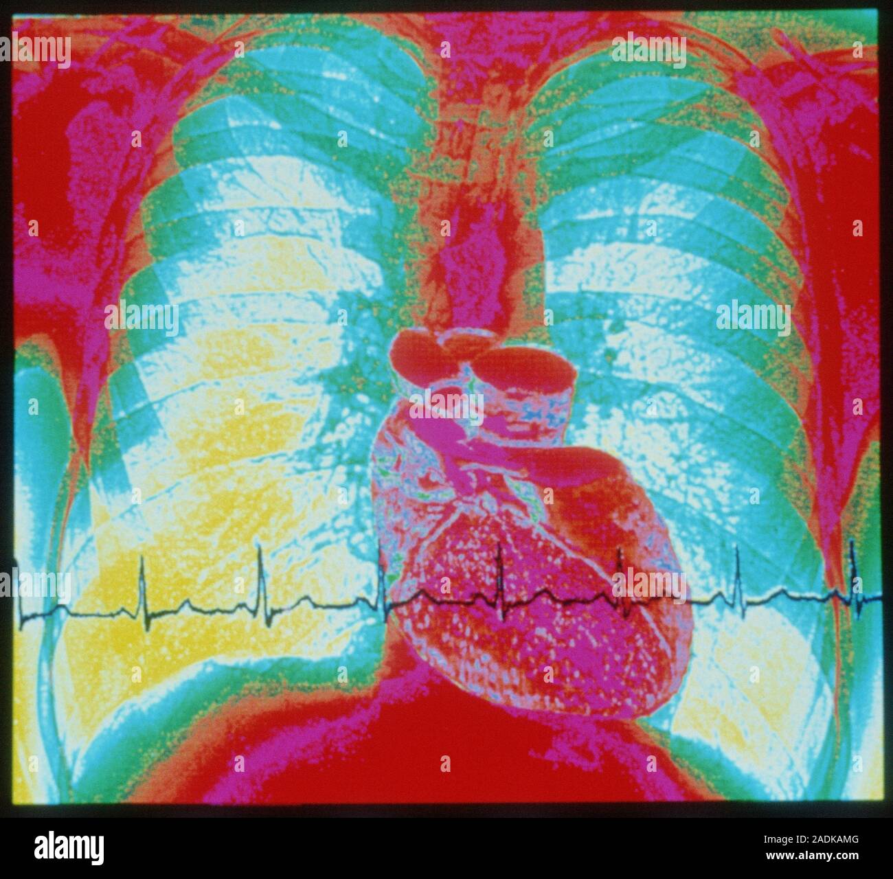 ECG trace with healthy heart & chest. Colour X-ray image of a human ...