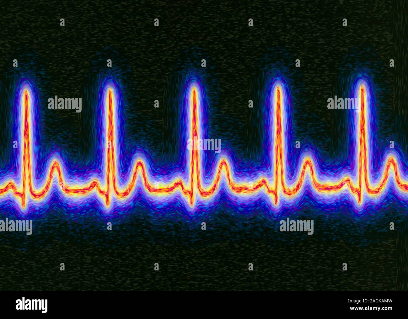 Healthy ECG heart trace. Computer-enhanced image of an ...