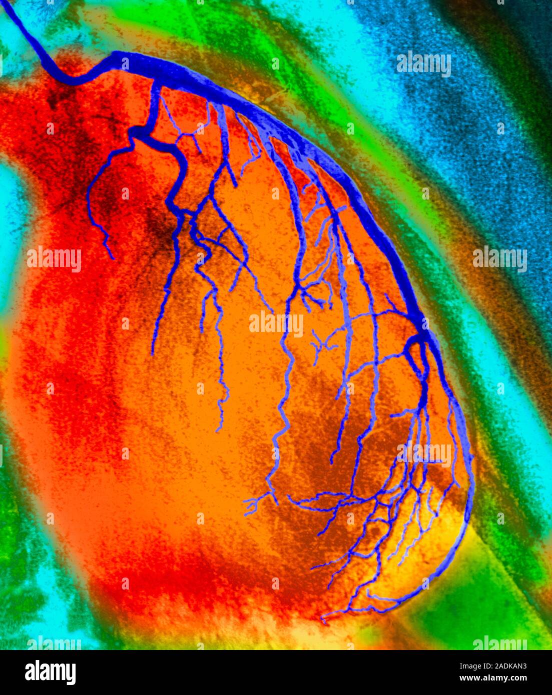 Coronary artery angiogram. Computer-enhanced coloured X-ray angiogram ...