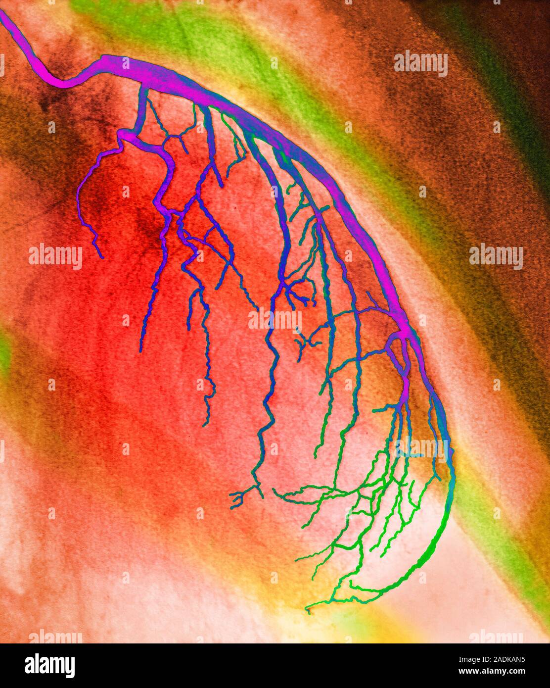 Coronary artery angiogram. Computer-enhanced coloured X-ray angiogram ...