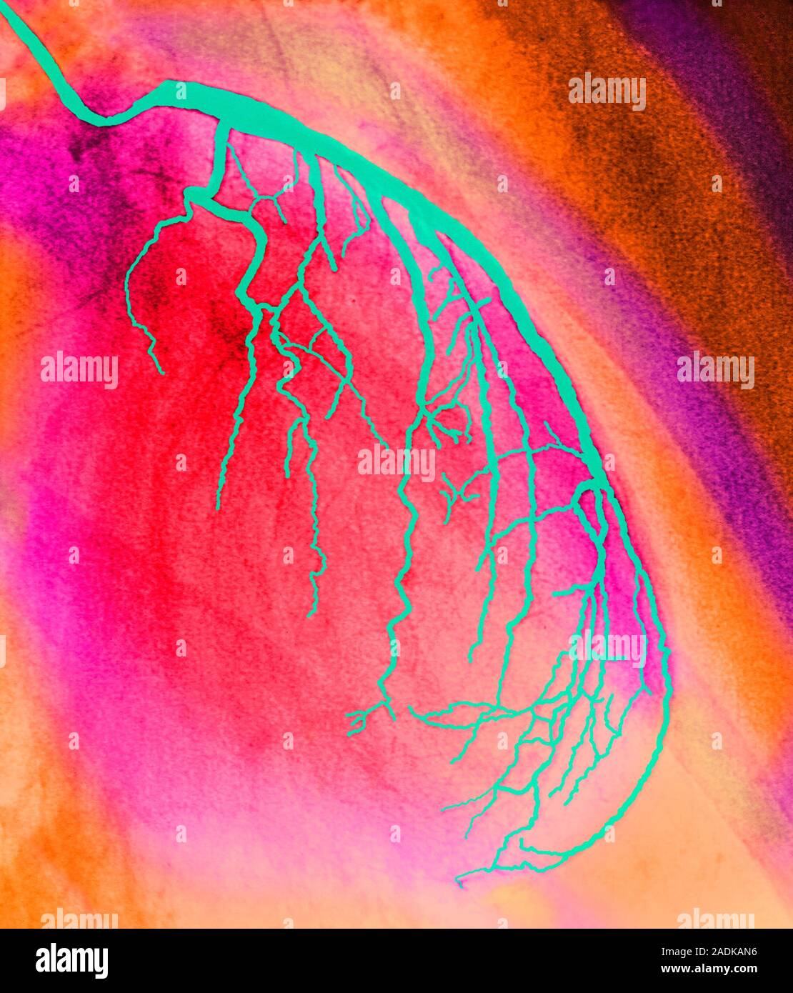 Coronary artery angiogram. Computer-enhanced coloured X-ray angiogram ...