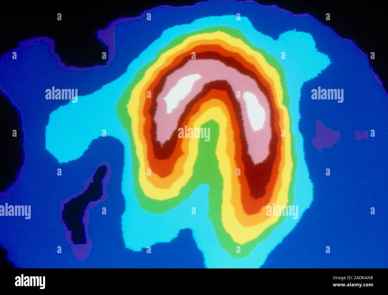 Healthy heart scan. Coloured gamma scan (scintigram) of a transverse ...