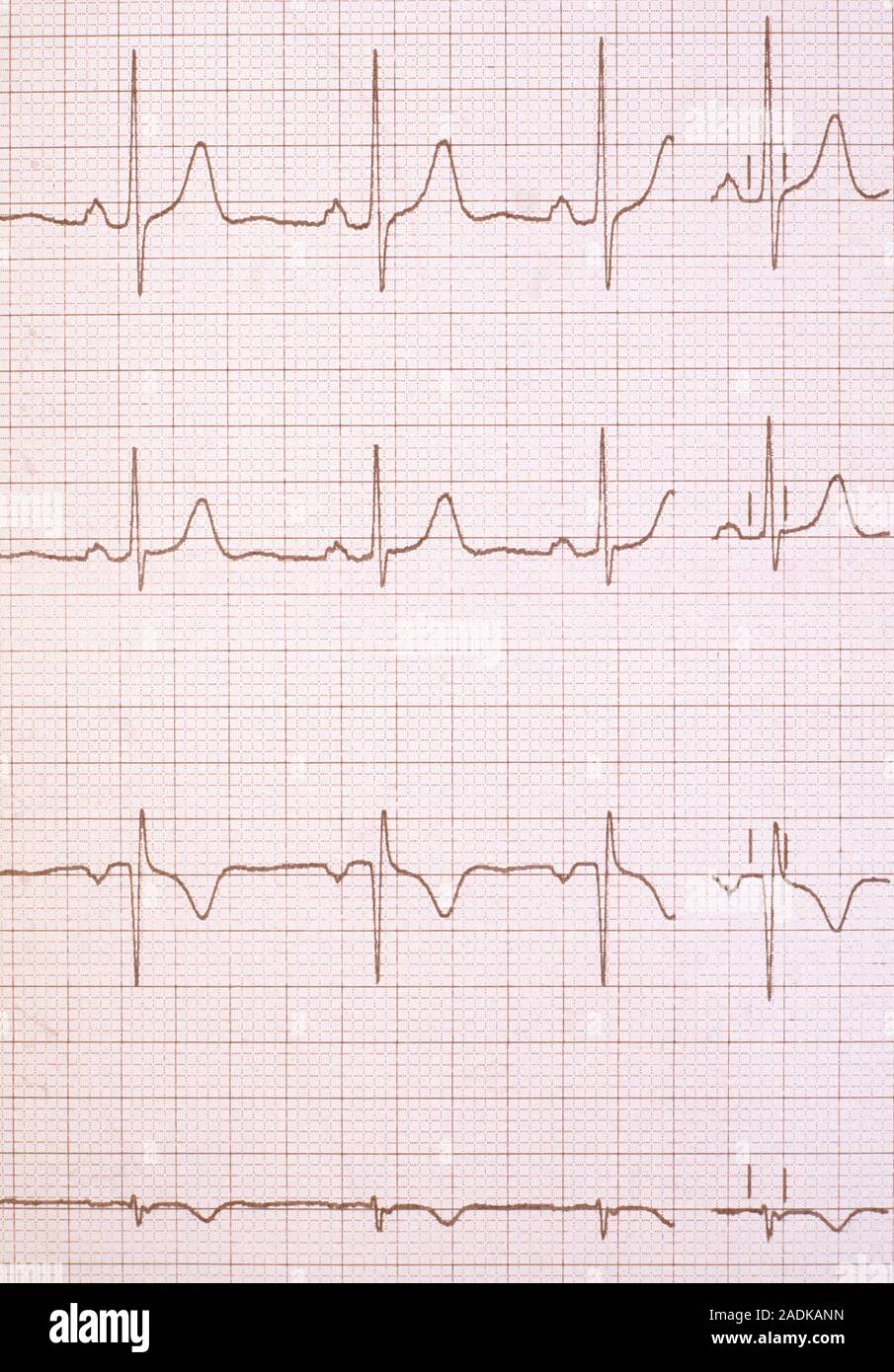Healthy ECG heart trace. Electrocardiogram (ECG) traces of a healthy ...
