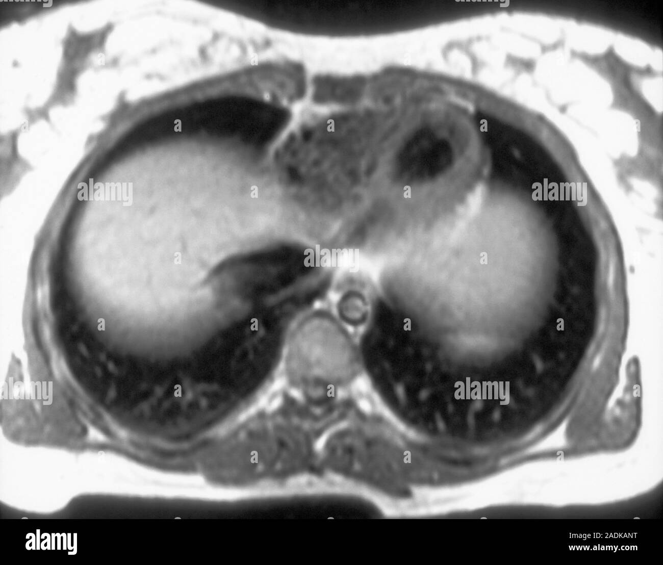 Healthy heart. Magnetic resonance imaging (MRI) scan of an axial ...