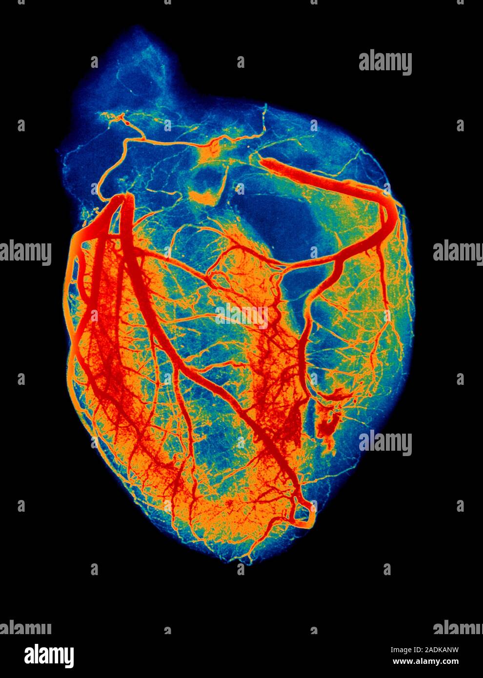 Healthy heart. Coloured arteriogram X-ray (or angiogram) showing in ...