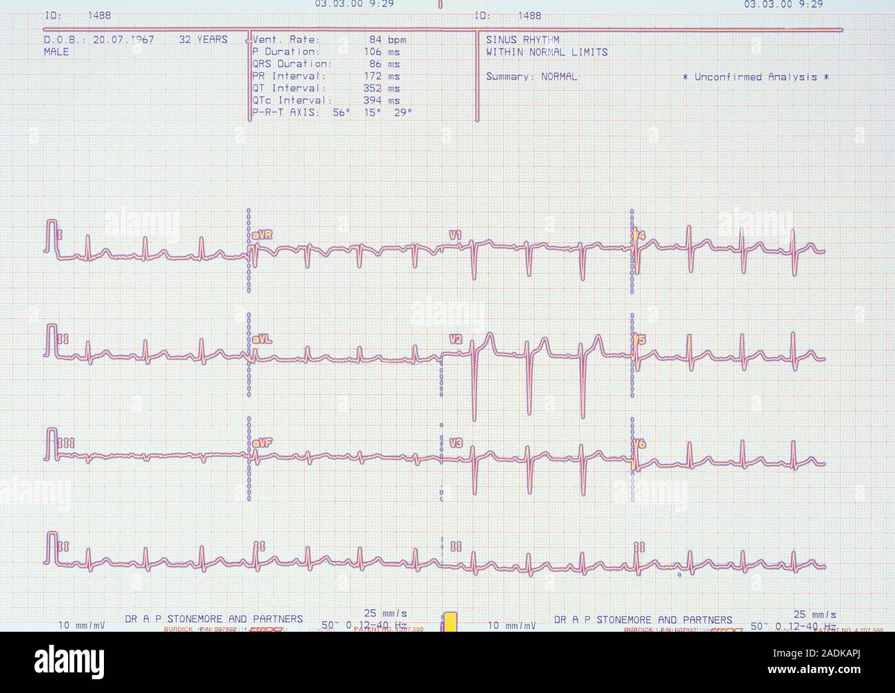 Healthy heart. Electrocardiogram (ECG) traces showing the healthy ...