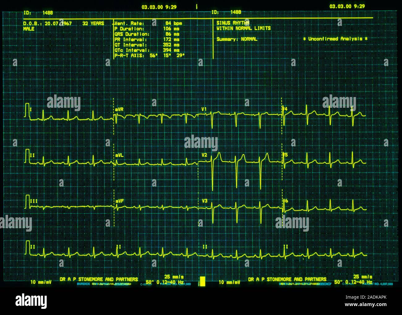 Healthy heart. Electrocardiogram (ECG) traces showing the healthy ...