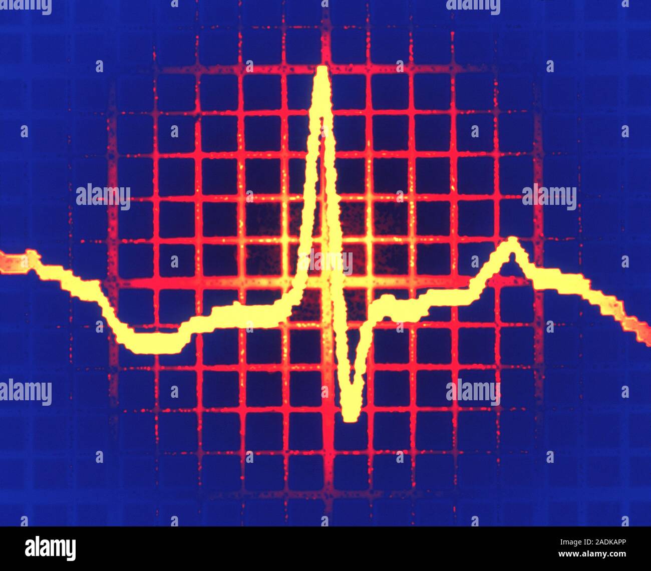 ECG trace. Computer artwork of an ECG (electrocardiogram) trace from a ...