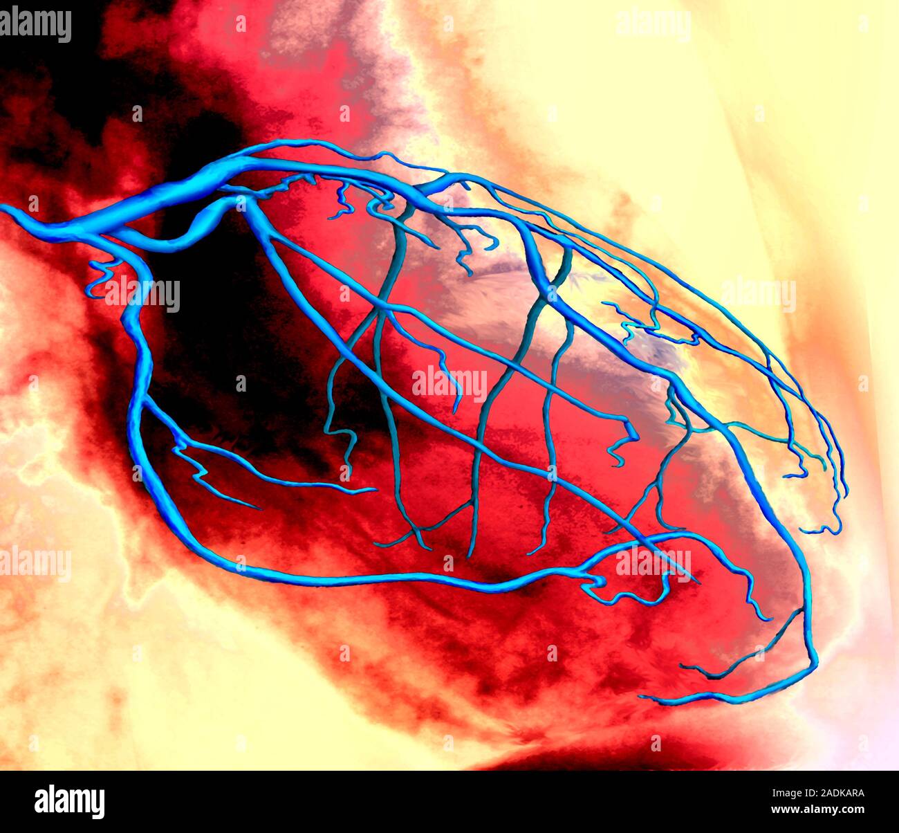 Coronary artery. Coloured X-ray angiogram of a healthy heart showing ...