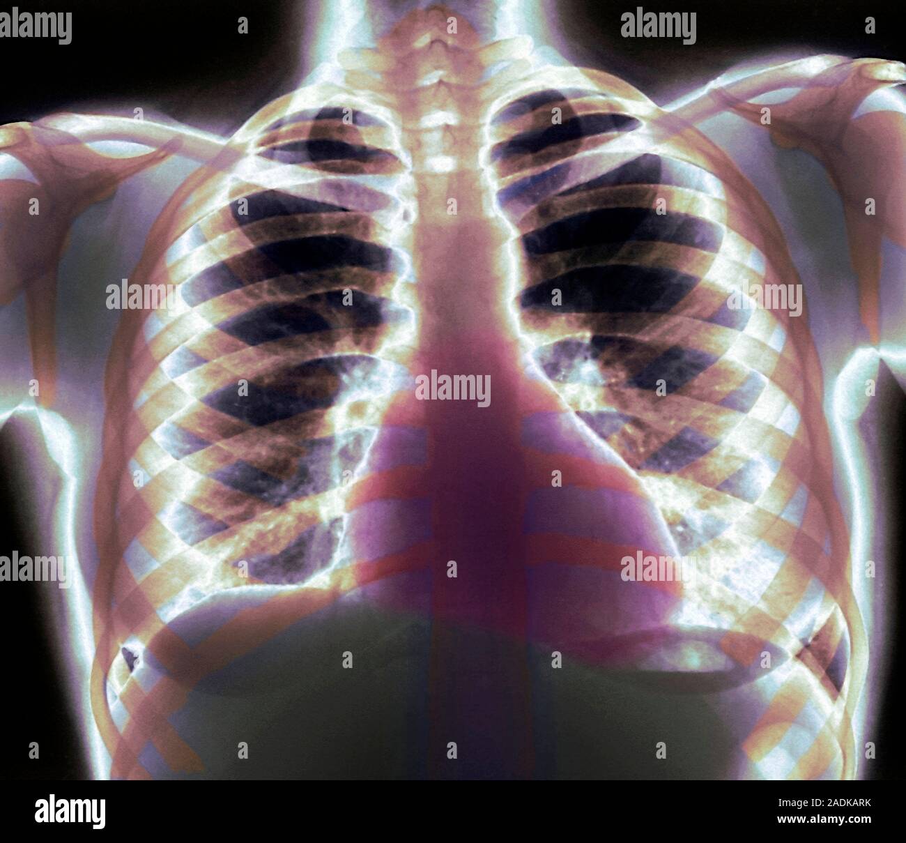 Healthy heart. Coloured X-ray of a chest showing a healthy heart ...