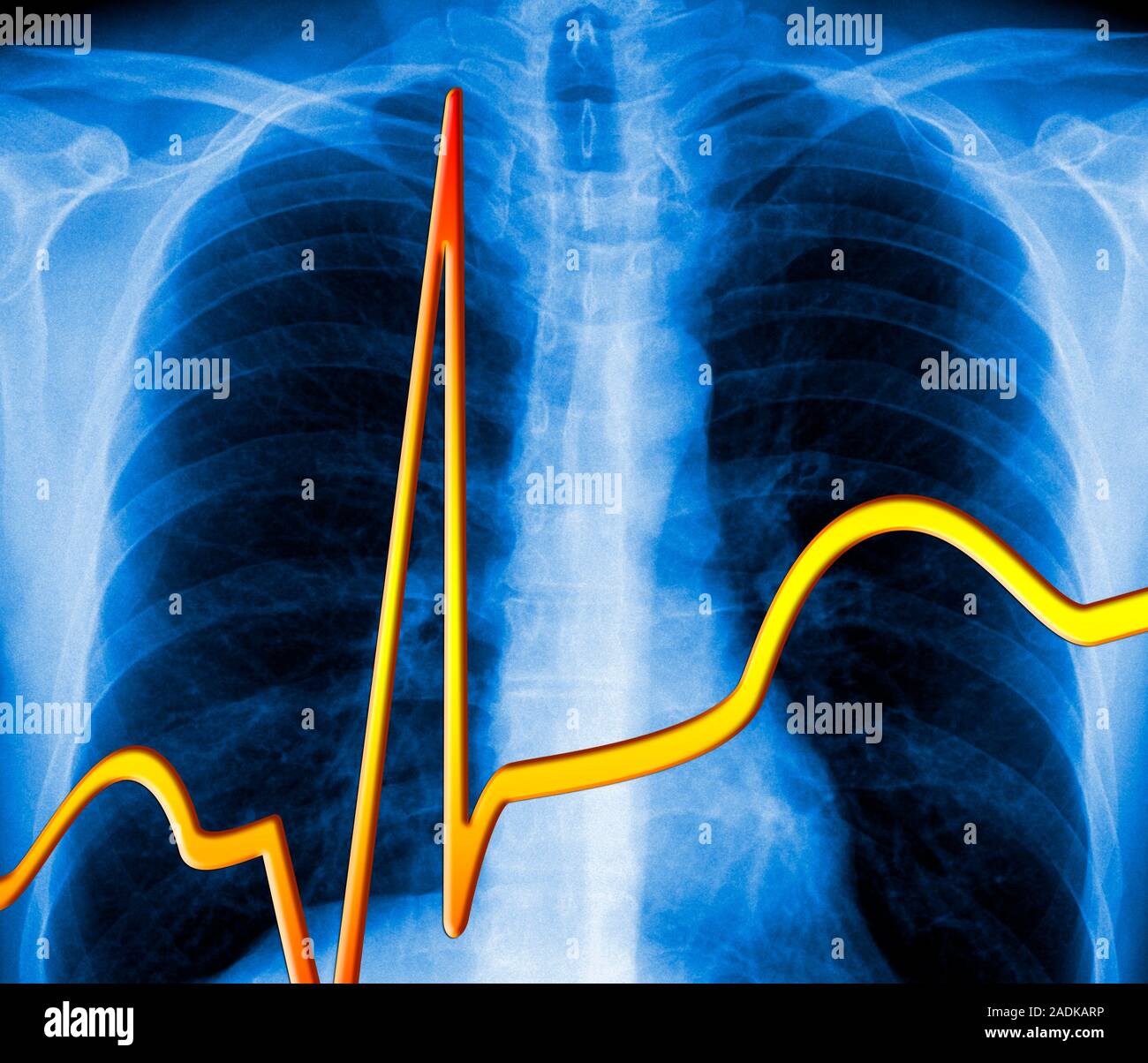 ECG trace. Computer artwork of an ECG (electrocardiogram) trace from a ...