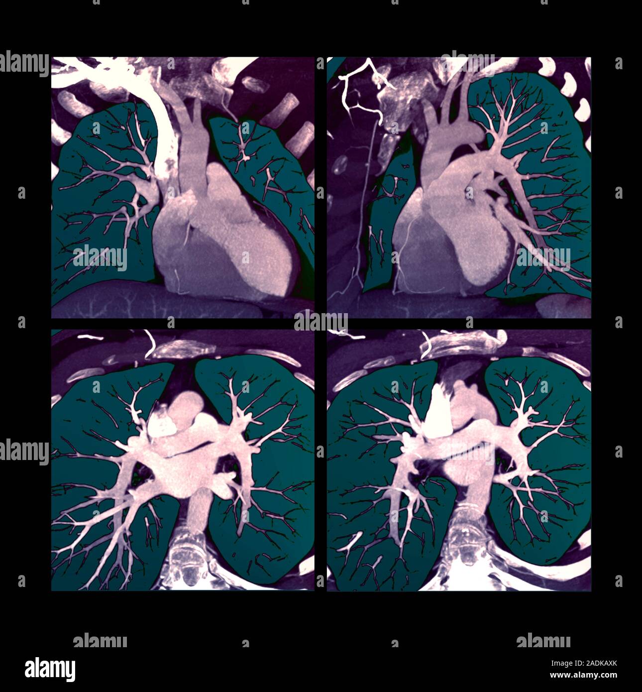 Heart. Coloured computed tomography (CT) scans of the healthy heart of ...
