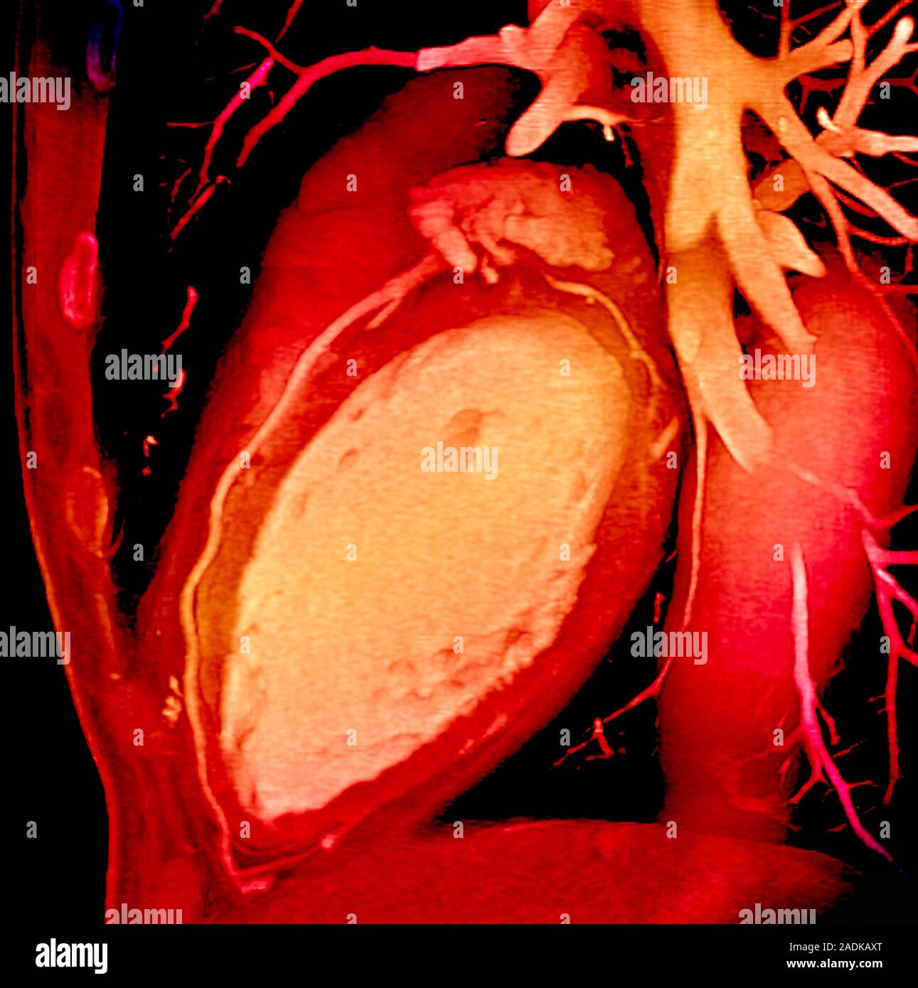 Heart. Coloured 3D computed tomography (CT) scan of the left side of ...