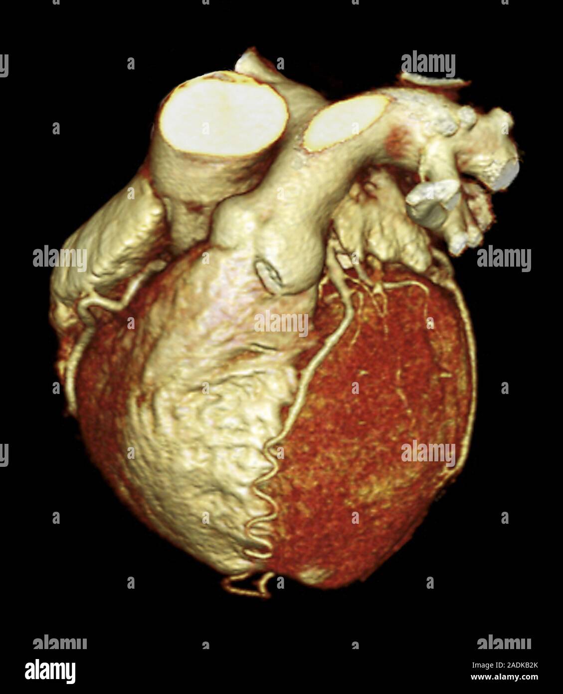 Heart. Coloured 3D computed tomography (CT) scan of an oblique view of the heart and its blood ...