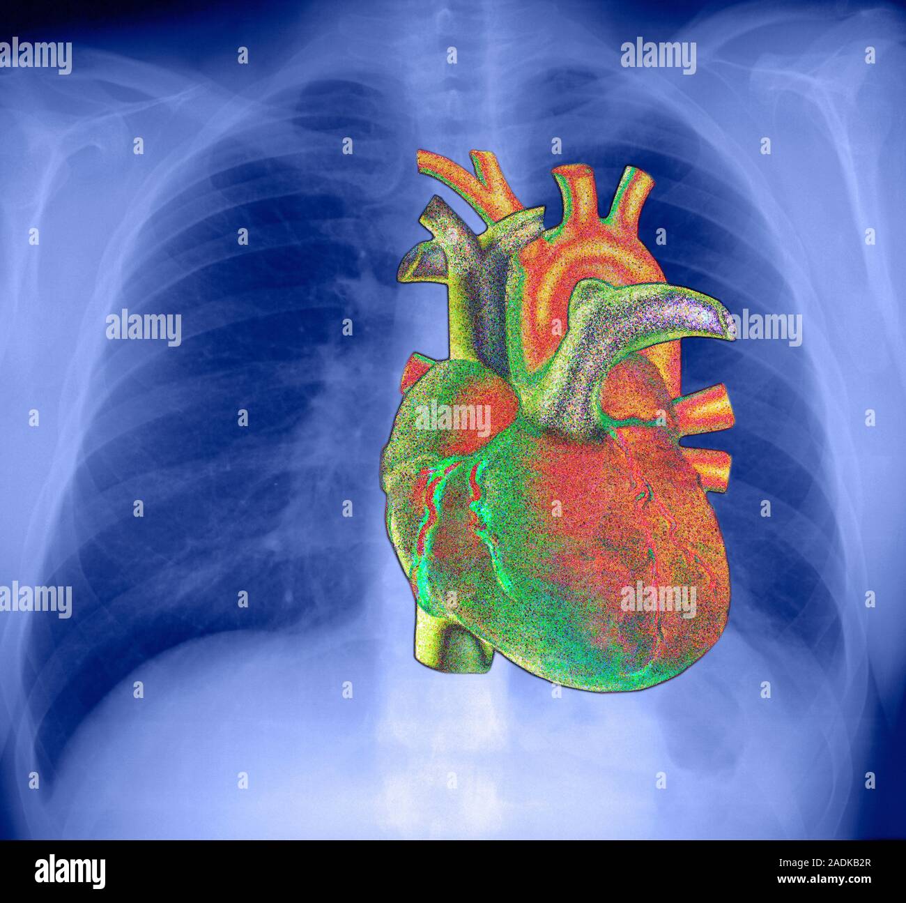 Heart. Computer artwork of a heart superimposed on a chest X-ray Stock ...