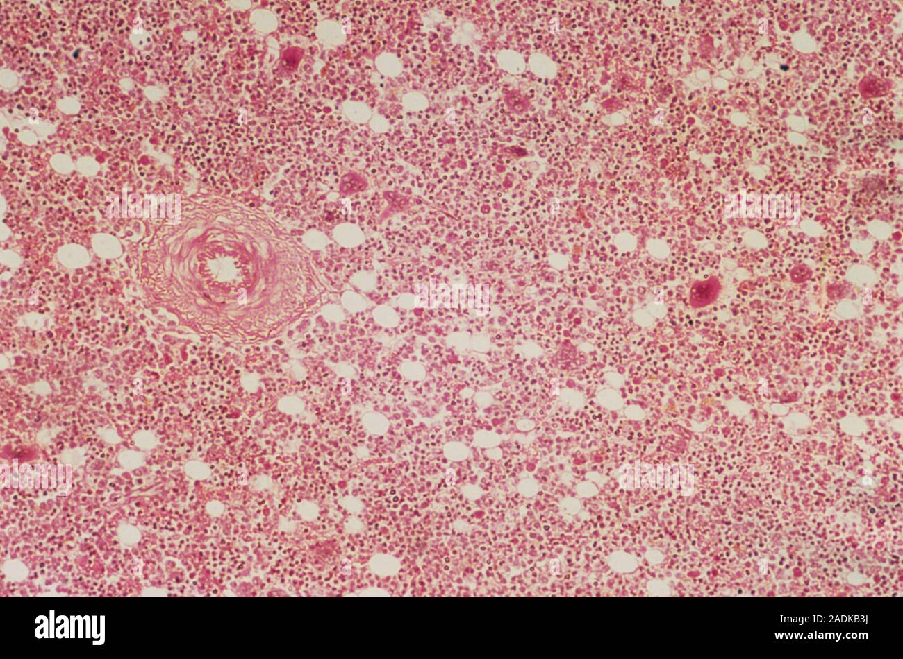 Light micrograph of human bone marrow which fills the intertrabecular ...
