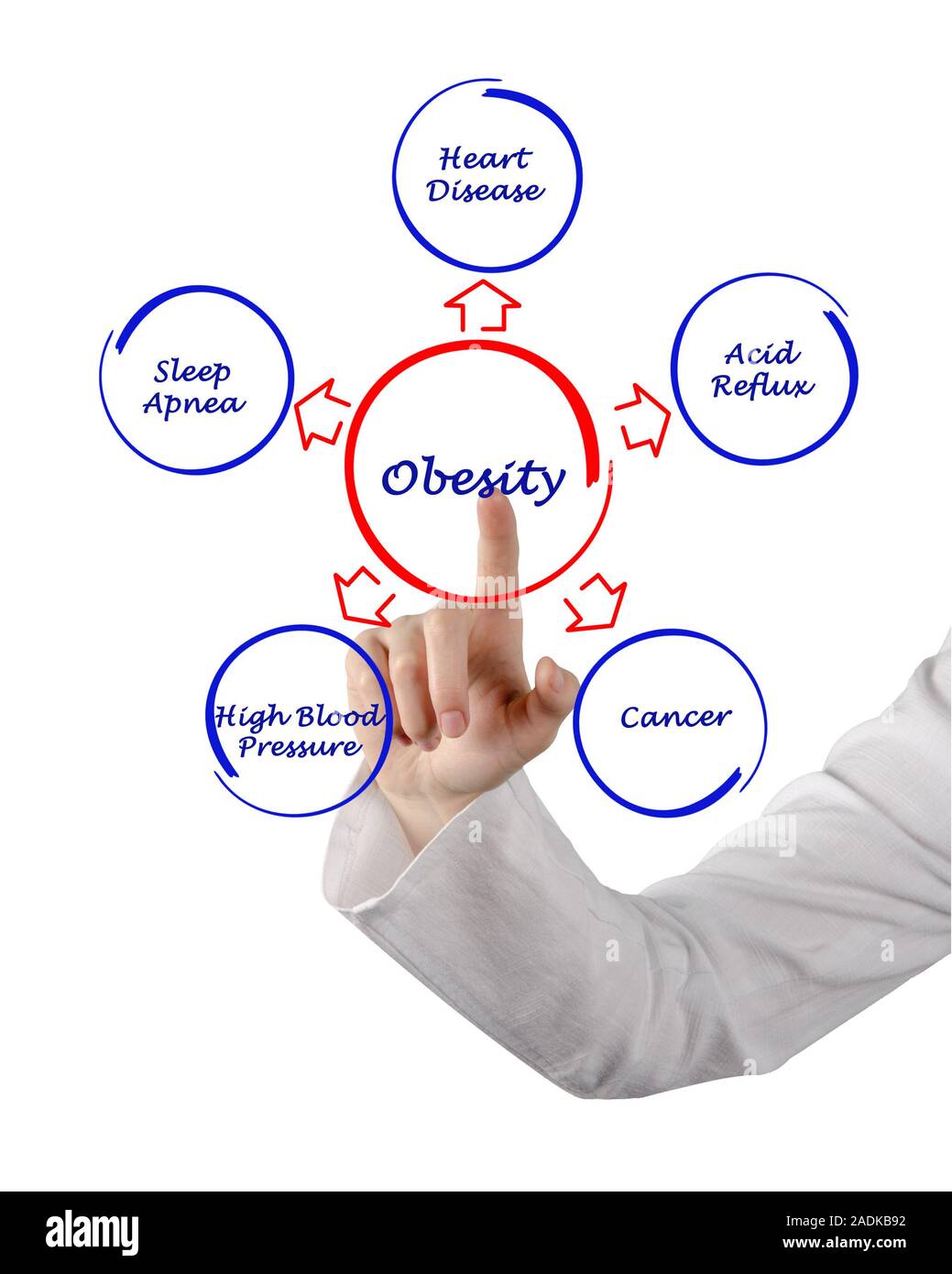 Obesity cancer hi-res stock photography and images - Alamy