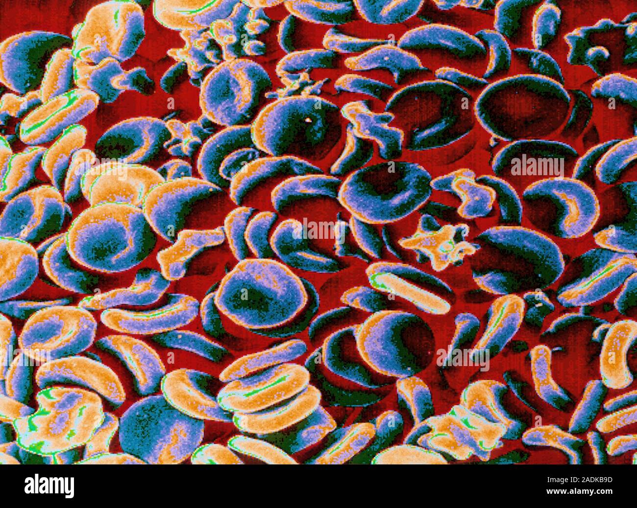 Red blood cells. Digitised coloured scanning electron micrograph (SEM ...