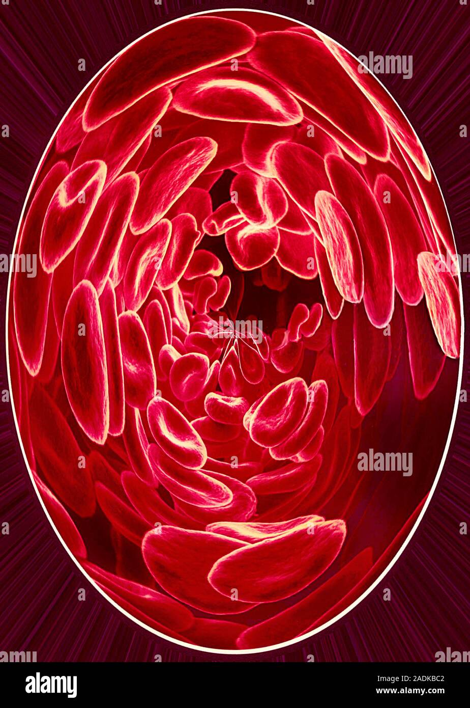 Red blood cells. Computer-enhanced scanning electron micrograph (SEM ...
