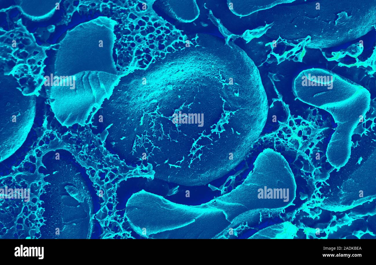 Red blood cells. Coloured scanning electron micrograph (SEM) of freeze ...