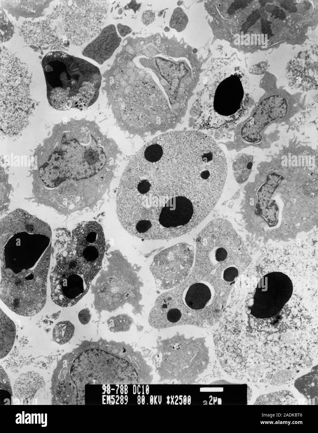 Apoptosis. Transmission electron micrograph (TEM) of a section through ...