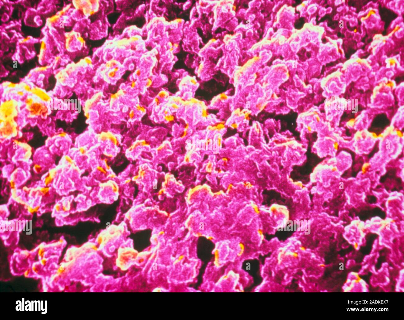 False-colour scanning electron micrograph (SEM) of a mass of human ...