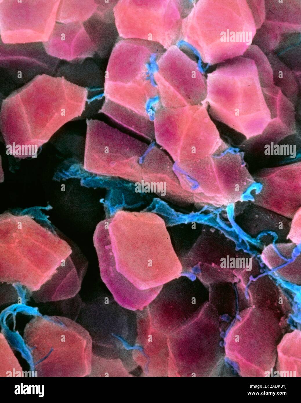 Blood clot. Coloured scanning electron micrograph of a blood clot. Thin ...