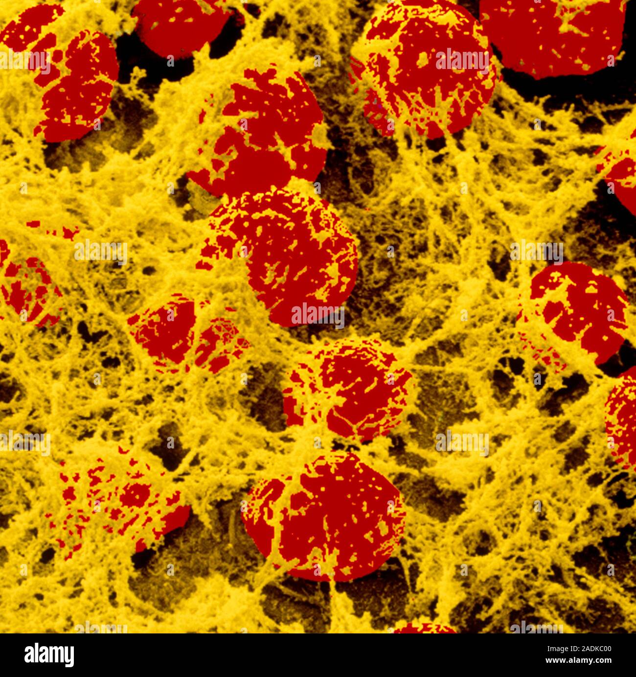 Blood clot. Coloured Scanning Electron Micrograph (SEM) of a human ...