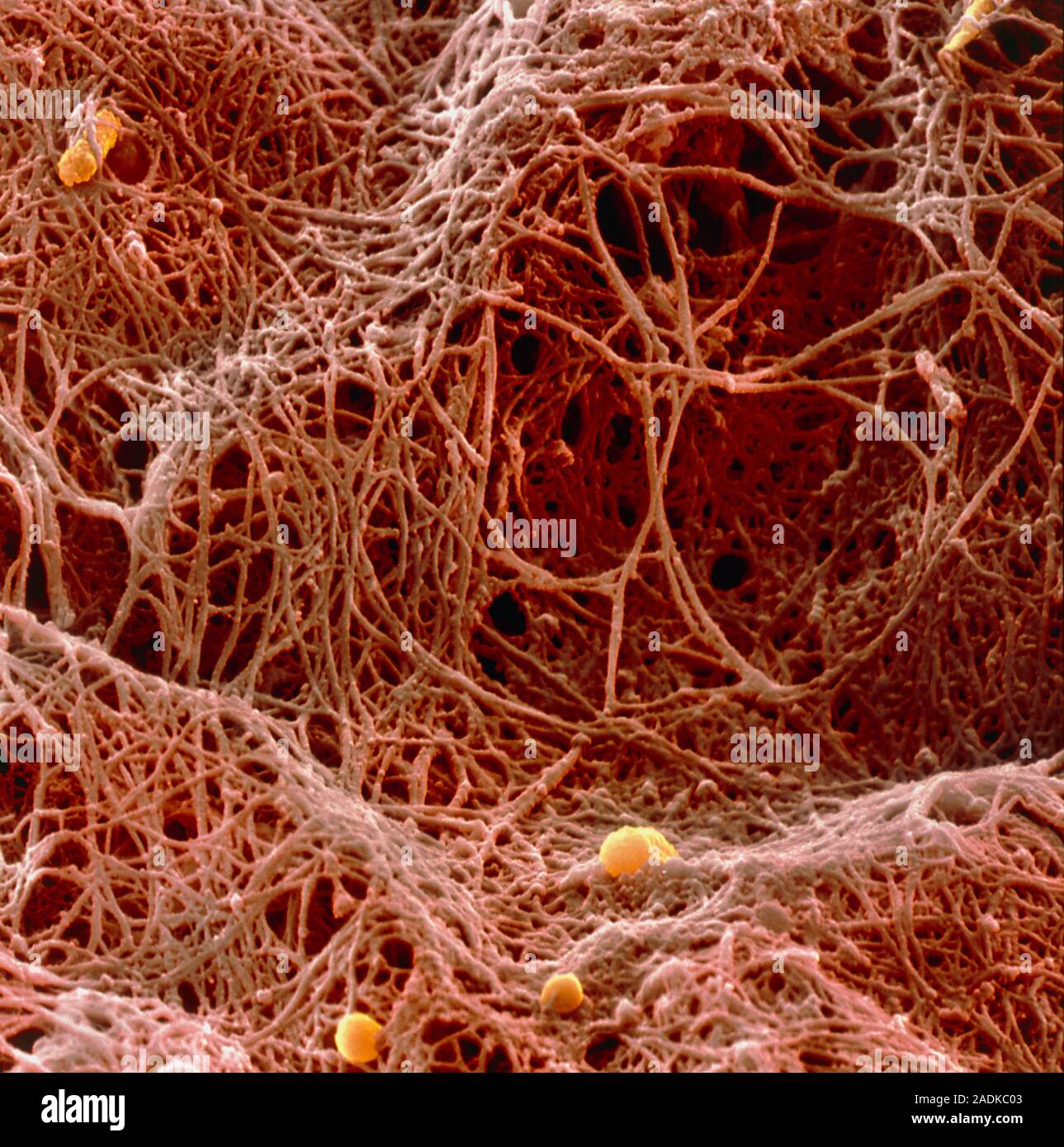 Blood clot. Coloured Scanning Electron Micrograph (SEM) of a human ...