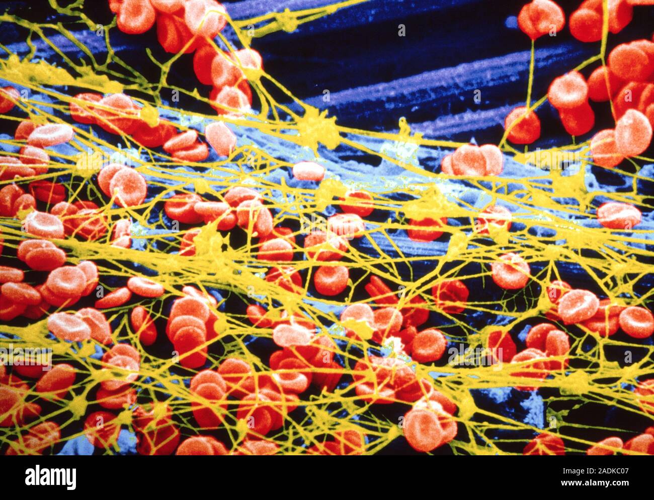 Blood clot. Coloured Scanning Electron Micrograph (SEM) of a human ...