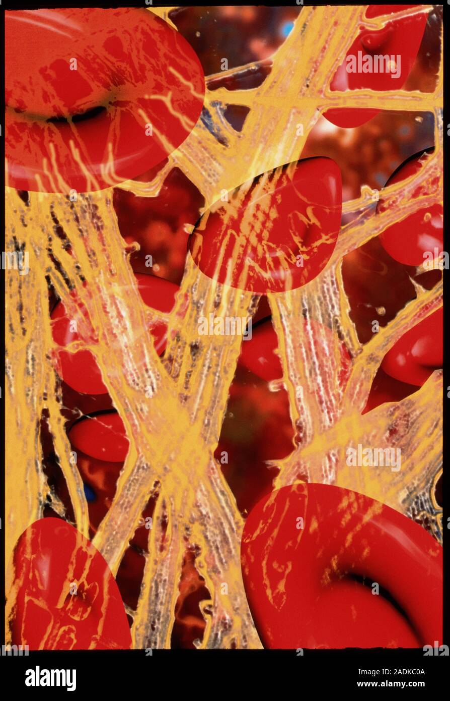 Blood clot. Computer illustration of a blood clot, showing red blood ...