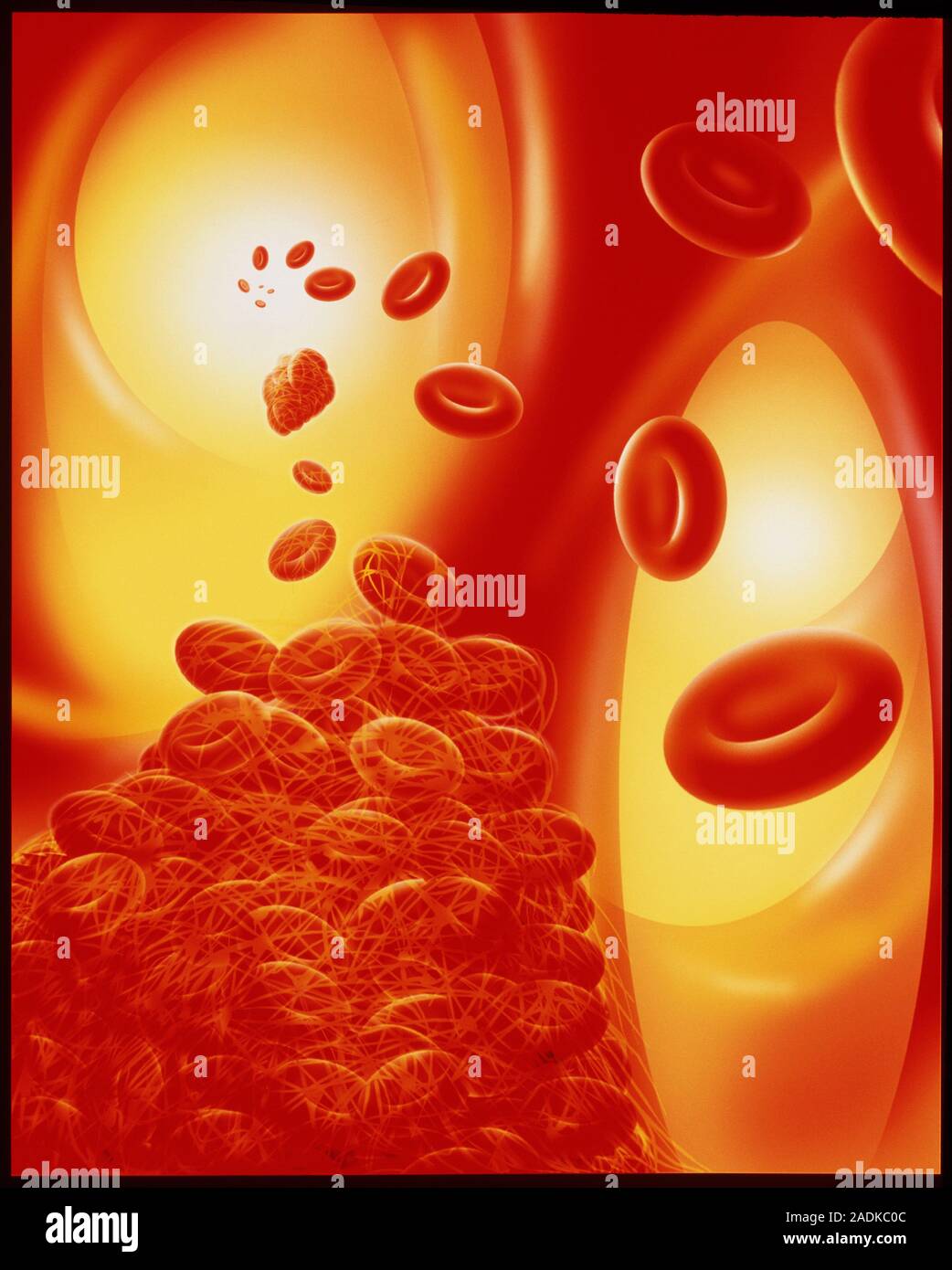 Blood clot. Computer artwork of a blood clot, showing red blood cells ...