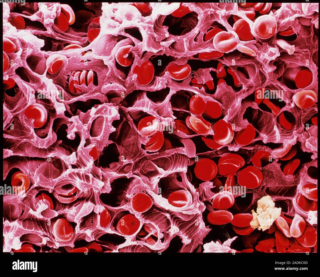 Blood clot. Coloured scanning electron micrograph (SEM) of a blood clot ...