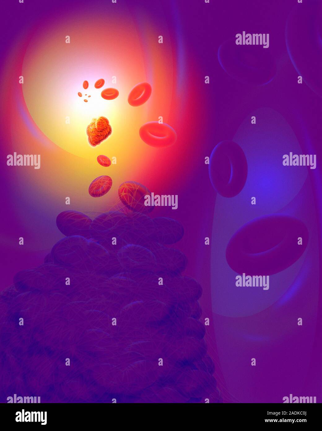 Blood clot. Computer artwork of a blood clot, showing disc-like red ...
