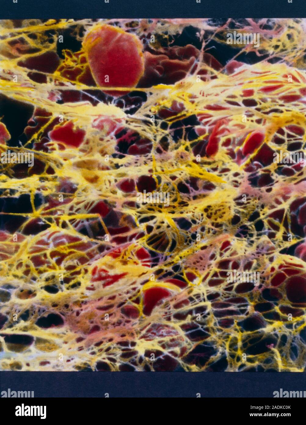 Blood clot. Coloured scanning electron micrograph (SEM) of a blood clot ...