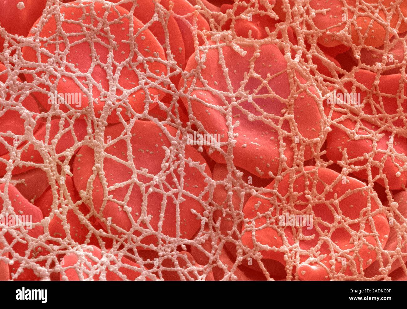 Blood clot. Coloured scanning electron micrograph (SEM) showing the ...