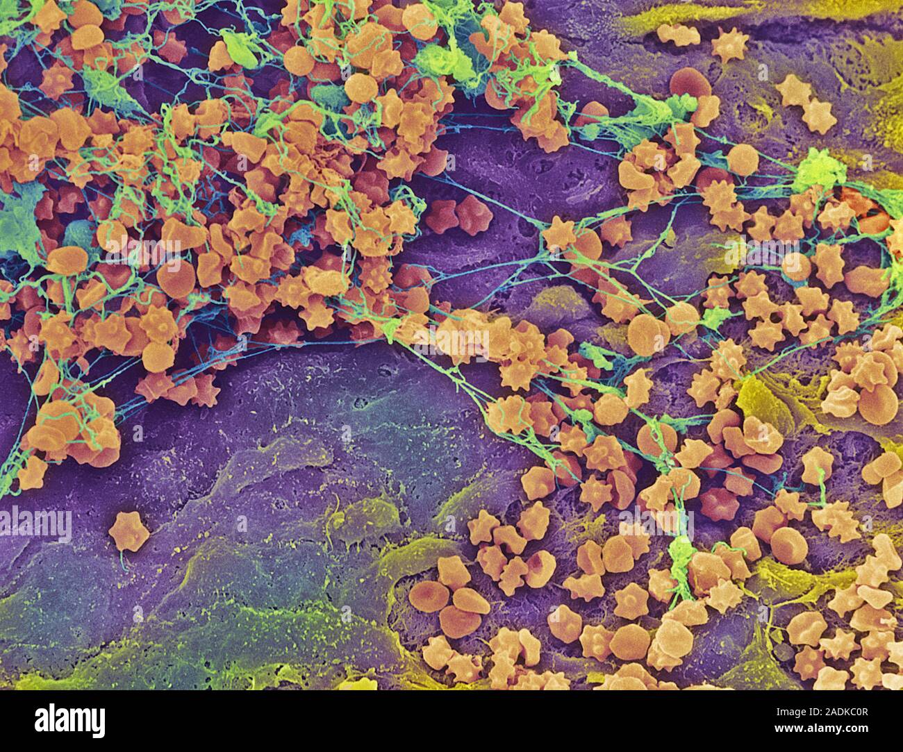 Blood clot. Coloured scanning electron micrograph (SEM) of a human ...