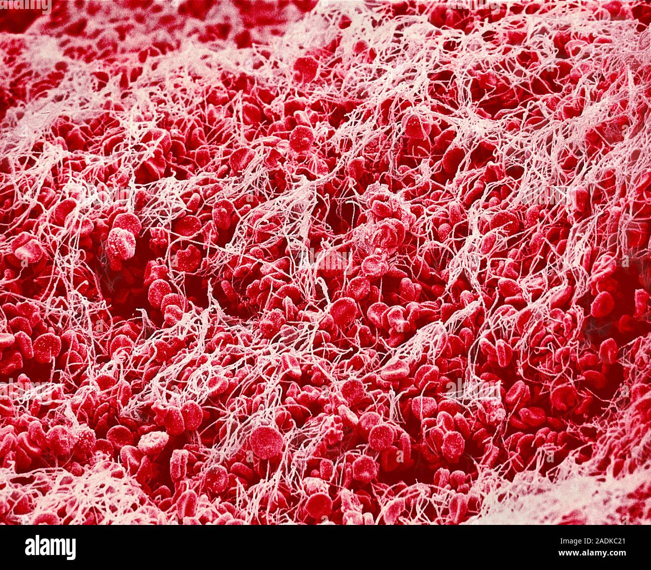 Blood clot. Coloured scanning electron micrograph (SEM) of clotted ...