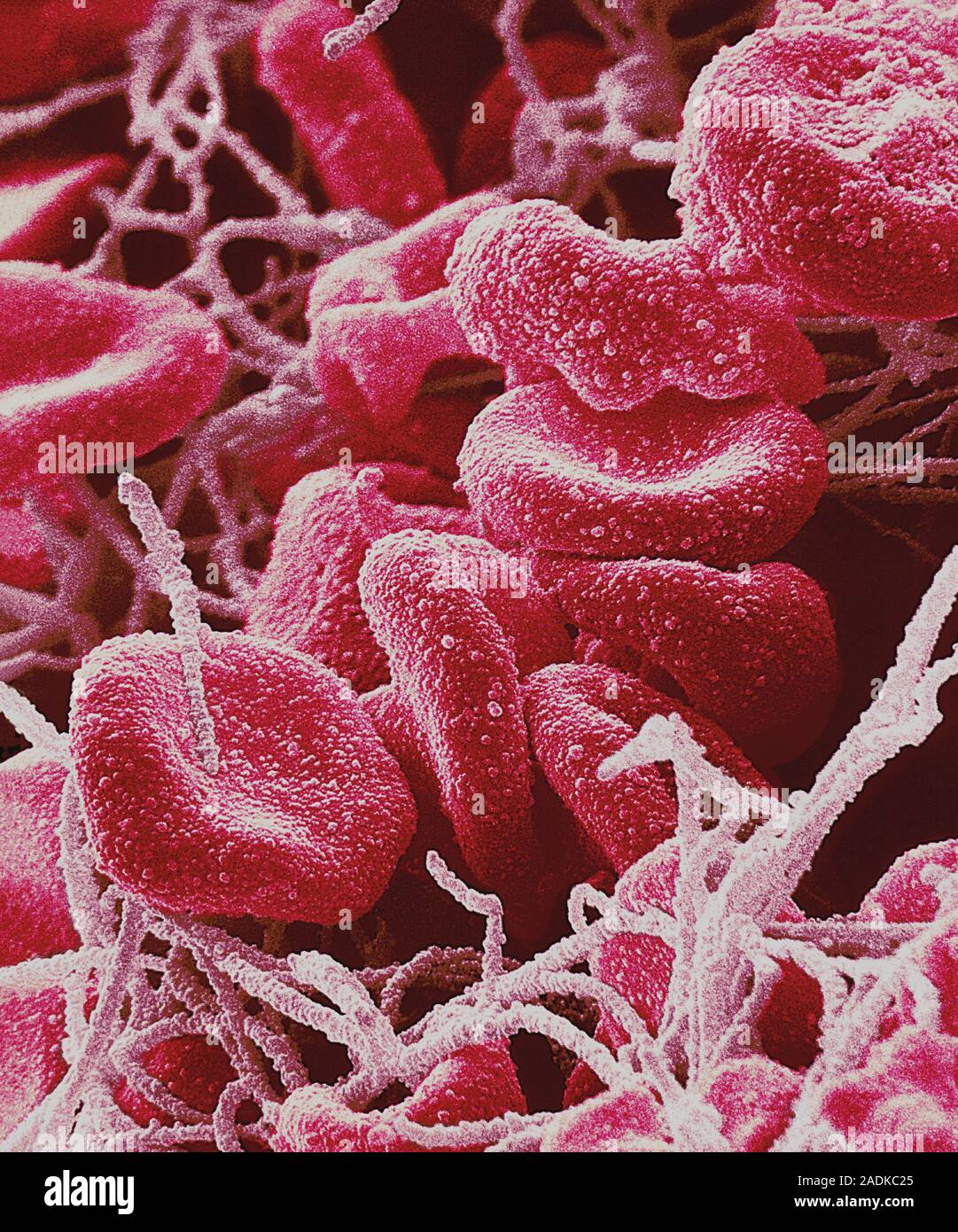 Blood clot. Coloured scanning electron micrograph (SEM) of a blood clot ...