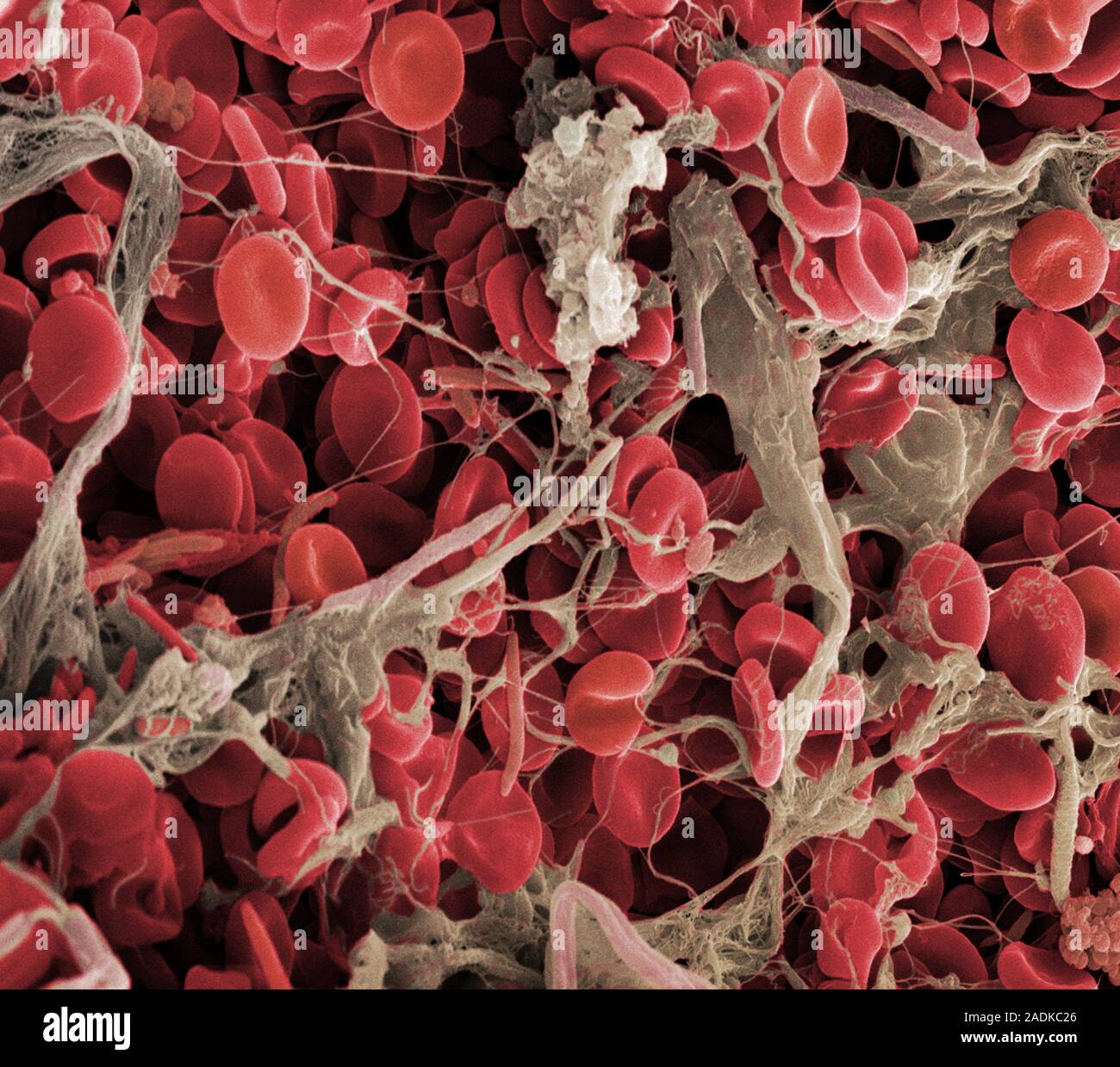 Blood clot. Coloured scanning electron micrograph (SEM) of a blood clot ...