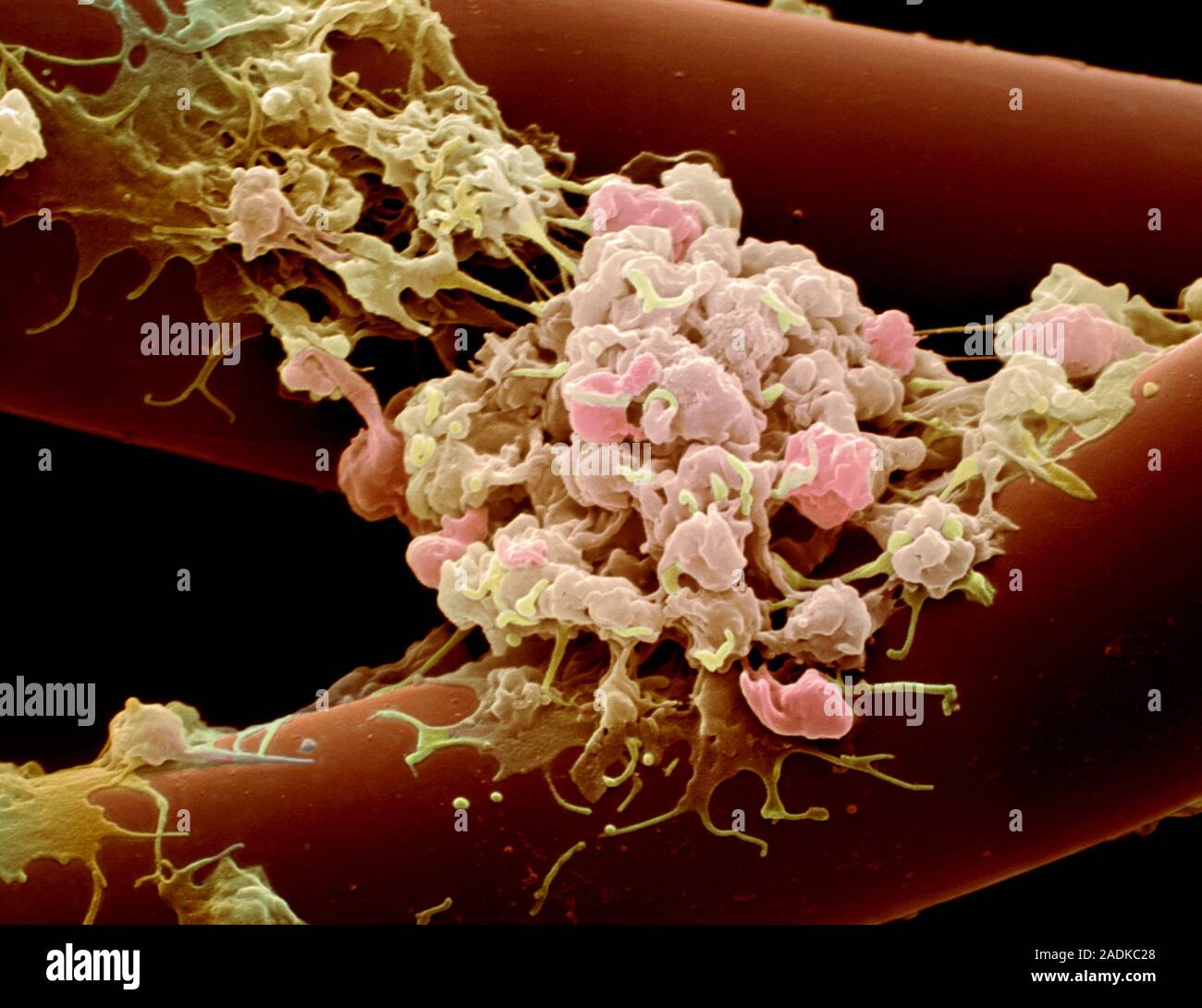 Activated platelets. Coloured scanning electron micrograph (SEM) of ...