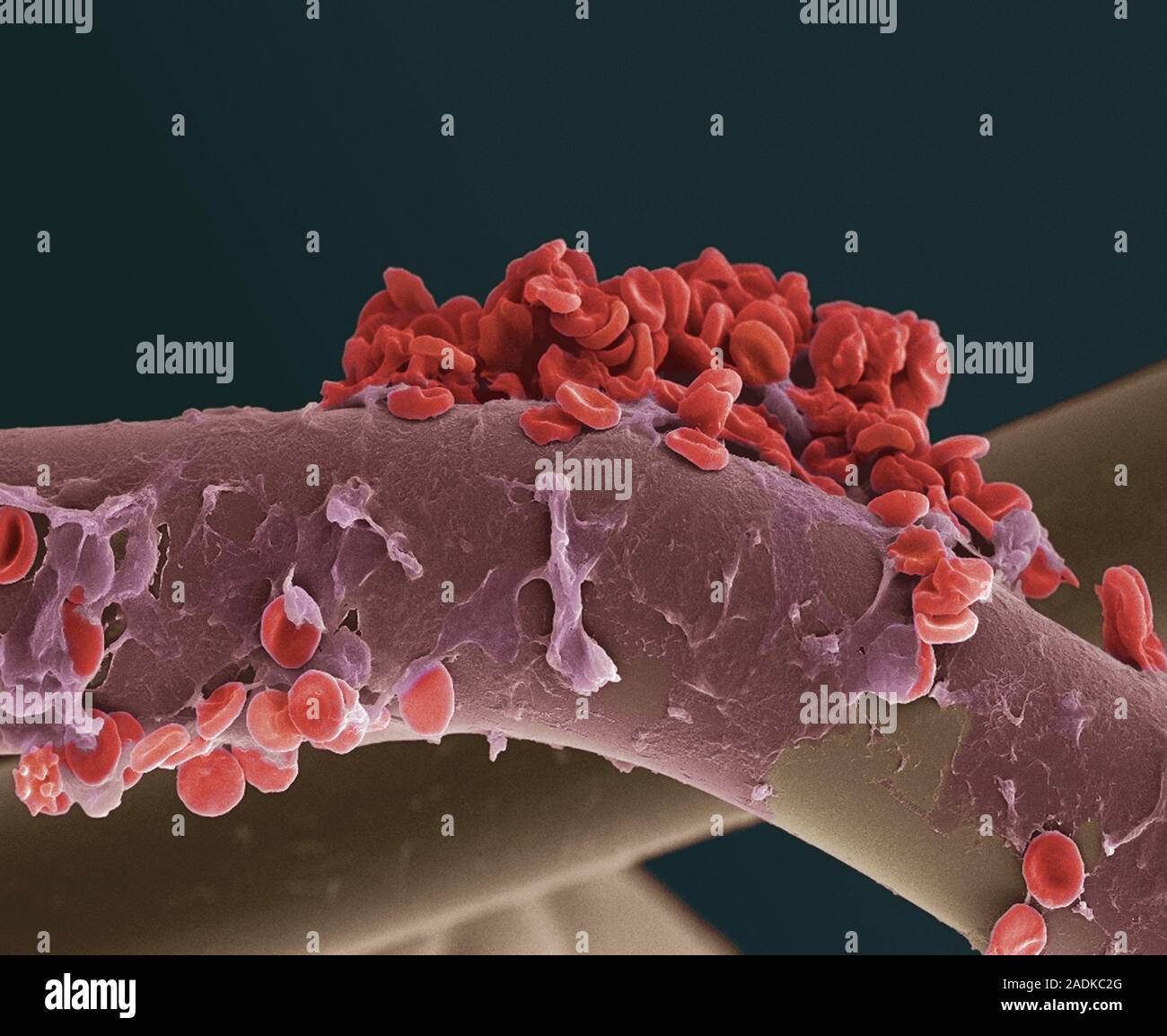 Blood clot. Coloured scanning electron micrograph (SEM) of a blood clot ...