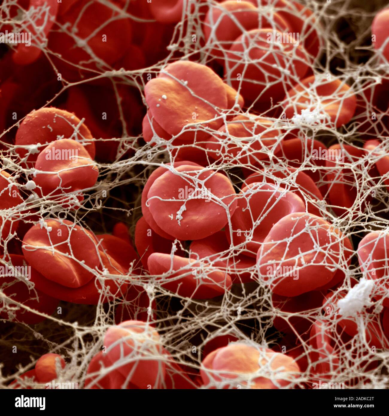 Blood clot. Coloured scanning electron micrograph (SEM) of a blood clot ...
