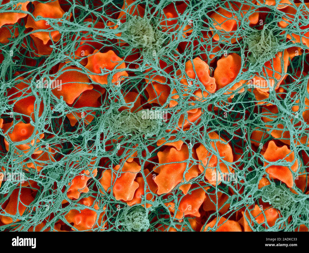 Blood clot. Coloured scanning electron micrograph (SEM) of red blood ...