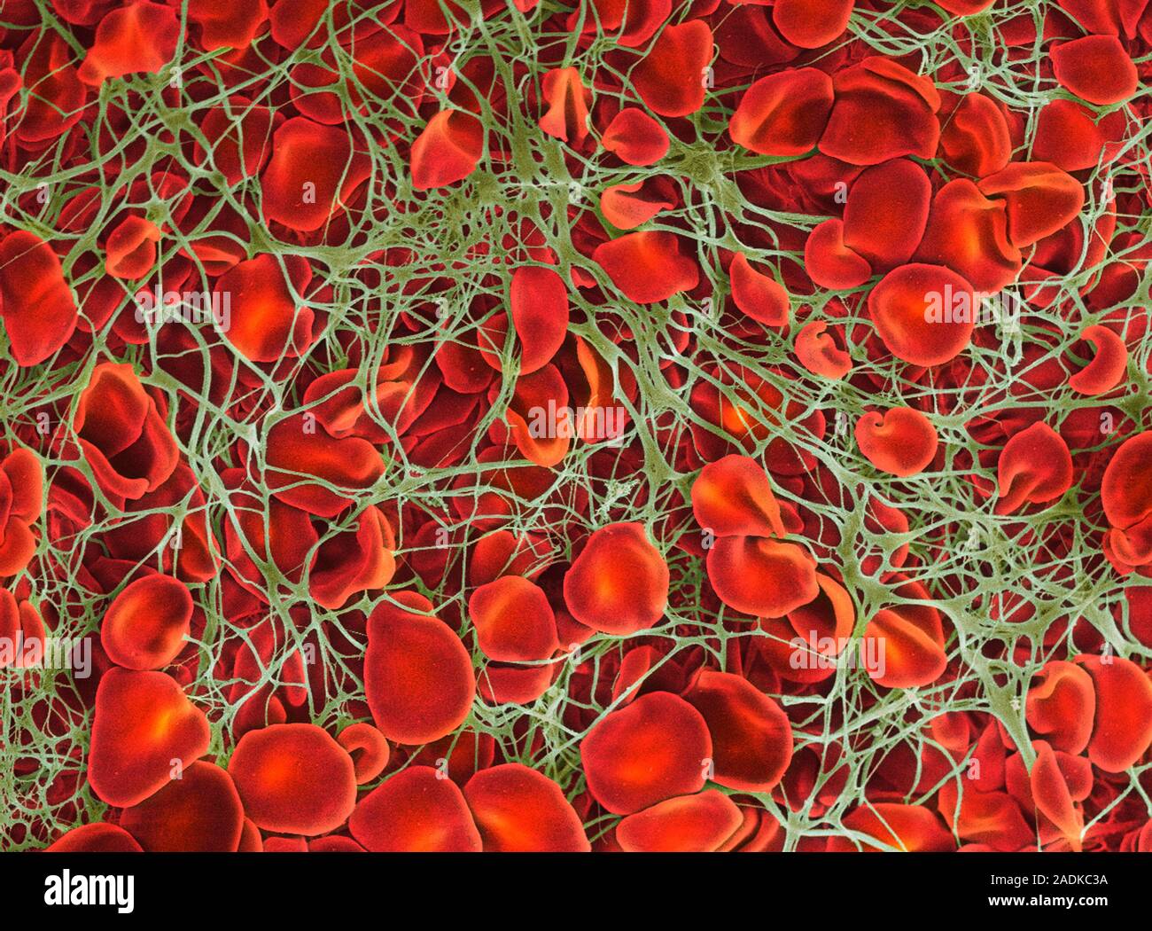 Blood clot. Coloured scanning electron micrograph (SEM) of red blood ...
