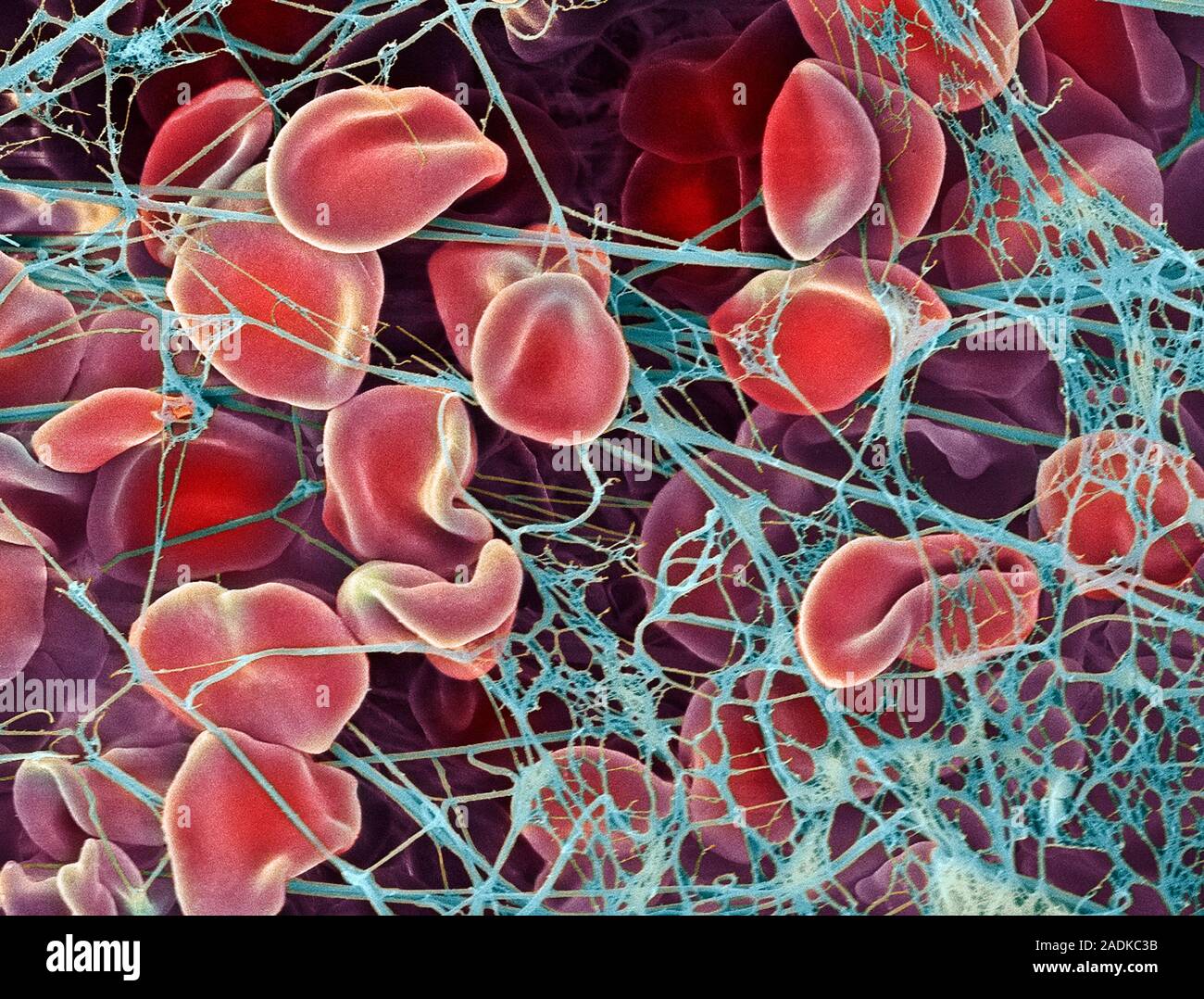 Blood clot. Coloured scanning electron micrograph (SEM) of red blood ...
