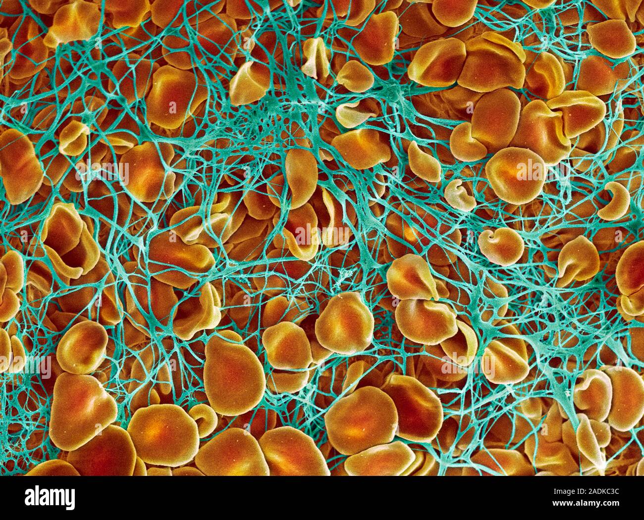 Blood clot. Coloured scanning electron micrograph (SEM) of red blood ...
